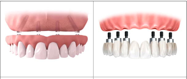 Dental Implant Fixed Bridge